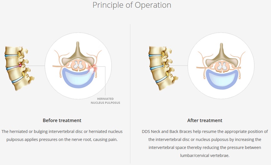DDS 300 Lumbar Decompression Belt Back Brace