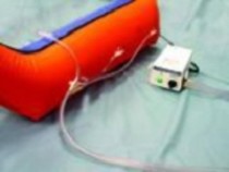 Lymphedema Pumps | Leg Compression Machines | Lymphedema Treatment ...