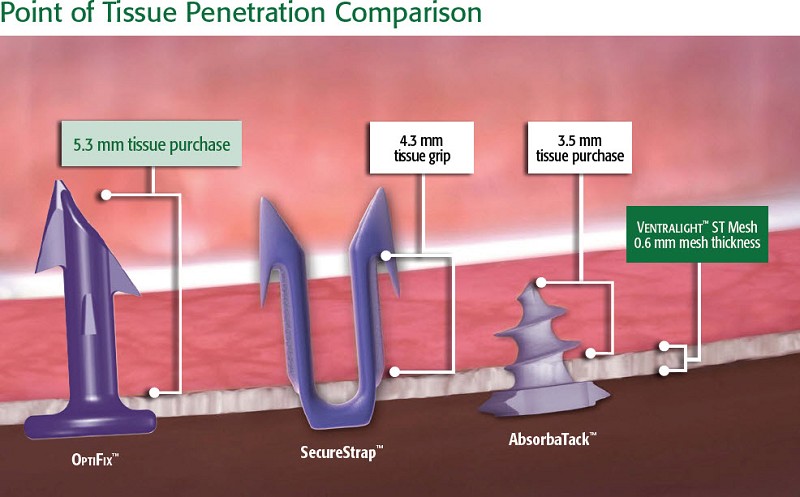 OptiFix 30 Shot Absorbable Fixation System, Case of 5