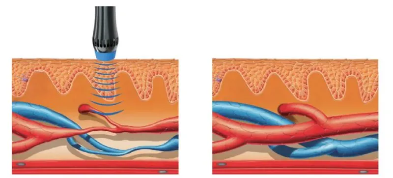 7 Conditions Shockwave Therapy Can Treat, Including Erectile ...