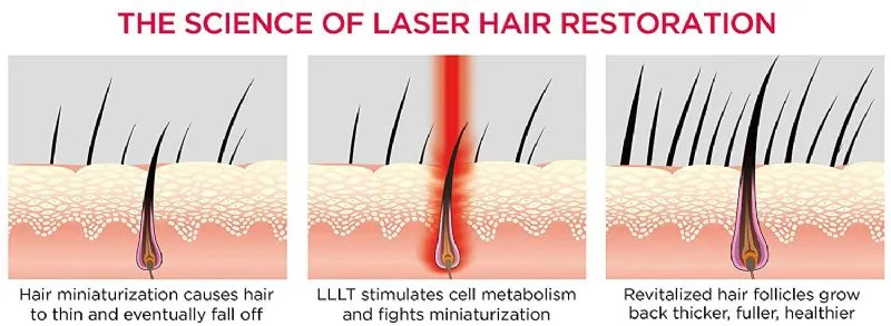 Low Level Laser Therapy Hair Loss [does It Really Work]